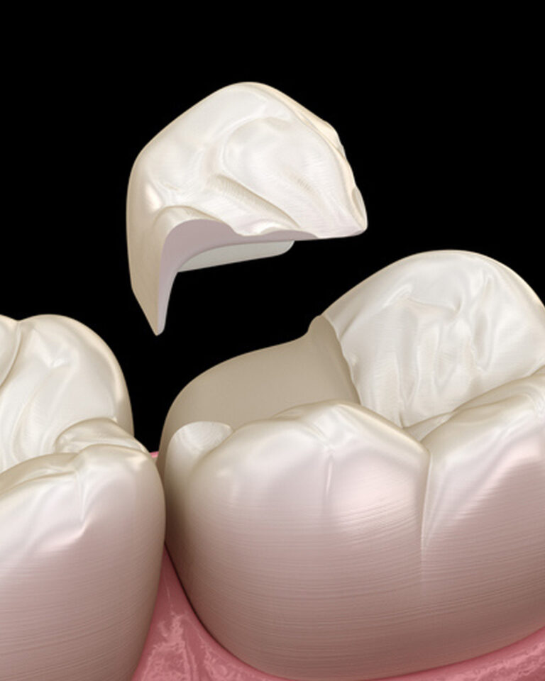 E-Max Esthetic Inlay and Onlay – Esthetic Dental Laboratory