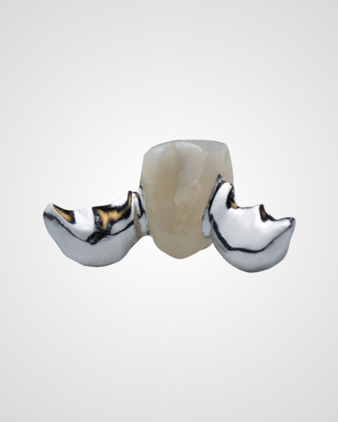 PFM Maryland Bridge – Esthetic Dental Laboratory