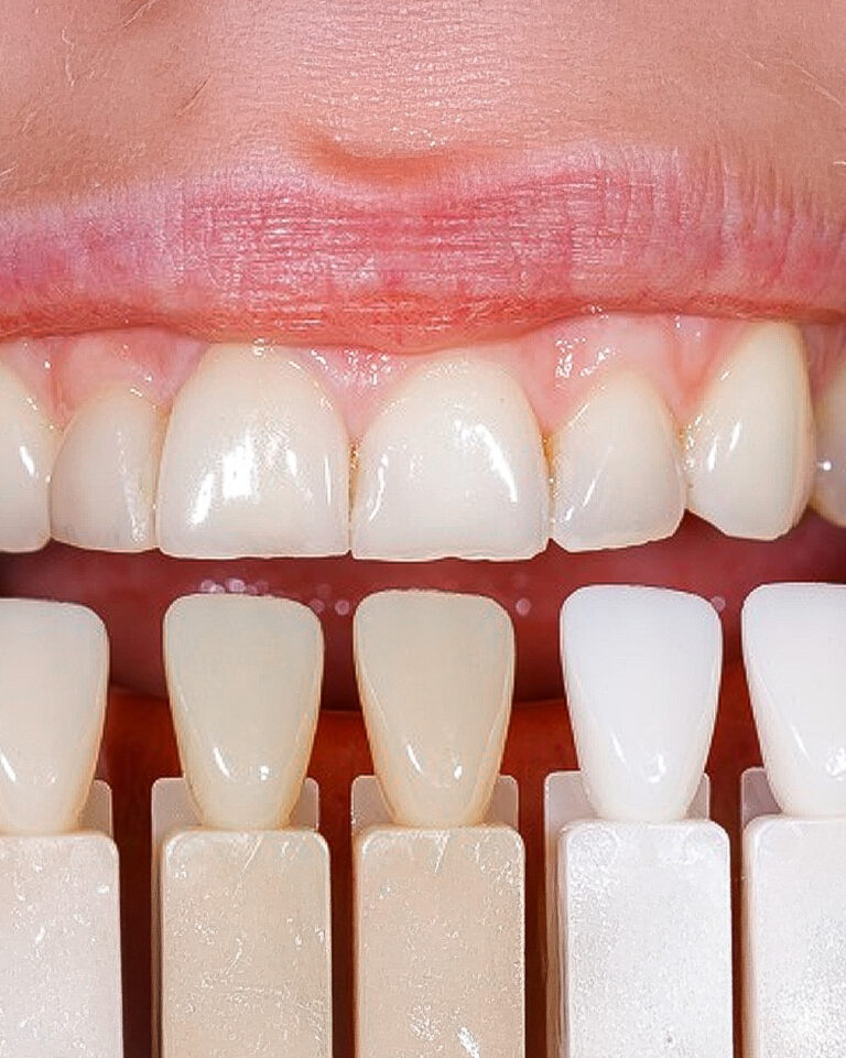 Shade Change – Esthetic Dental Laboratory